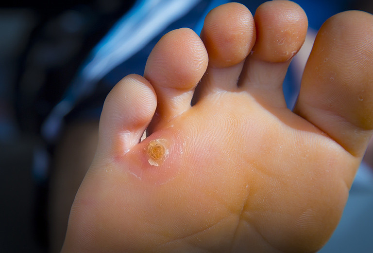 Callus - Definisi, Penyebab, Gejala, dan Tata Laksana | AI Care