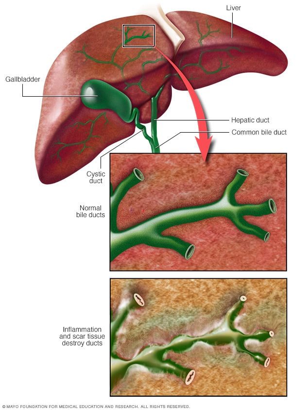 Disease Primary Biliary Cholangitis | AI Care