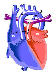 Transposition of the Great Arteries (TGA) - Definition, Causes ...