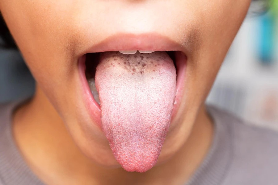 Oral Candidiasis - Definition, Causes, Symptoms, and Treatment | AI Care