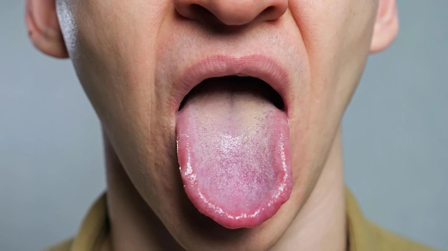 Glossitis - Definition, Causes, Symptoms, and Treatment | AI Care