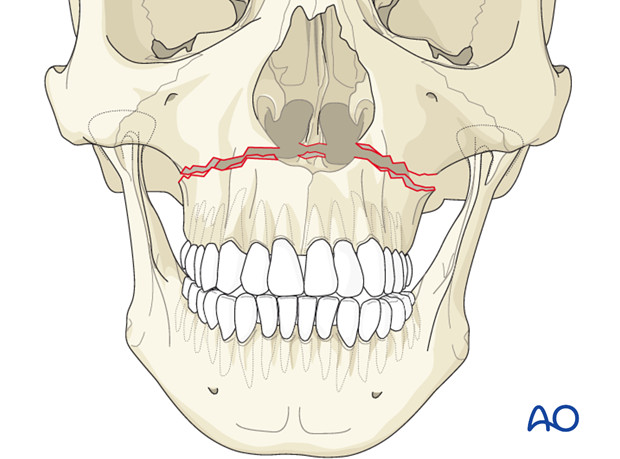 Mandible Fracture - Definisi, Penyebab, Gejala, dan Tata Laksana | AI Care