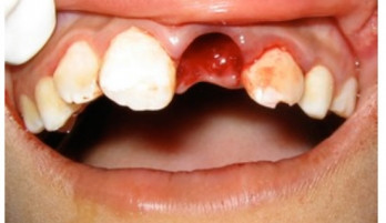 Disease Dental Avulsion | AI Care