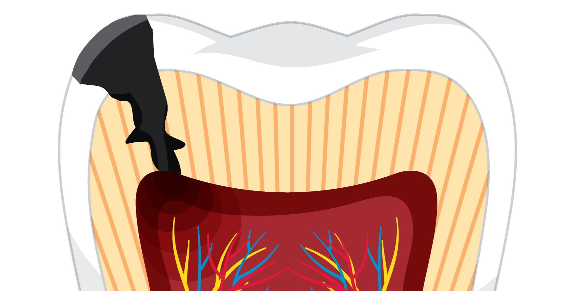 Pulpitis - Definisi, Penyebab, Gejala, dan Tata Laksana | AI Care