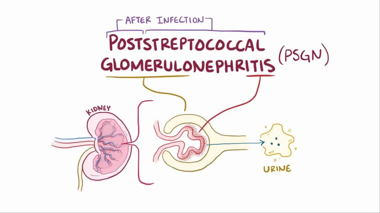 Disease Acute Post-Streptococcal Glomerulonephritis | AI Care