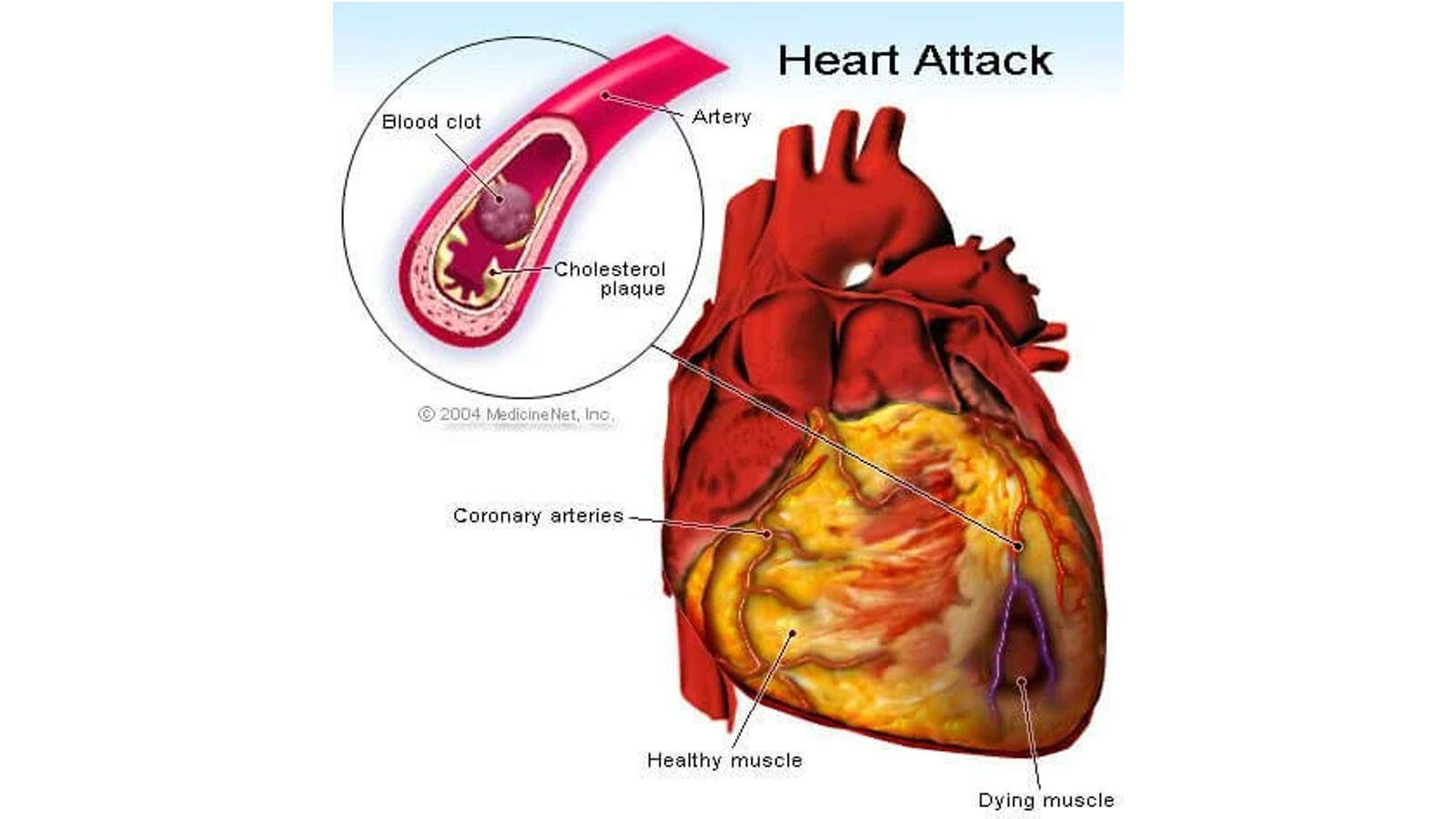 Heart Attack (Myocardial Infarction) - Definisi, Penyebab, Gejala, dan ...
