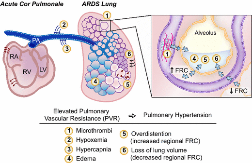 Acute Cor Pulmonale - Definition, Causes, Symptoms, and Treatment | AI Care