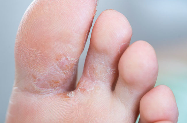 Tinea Pedis - Definition, Causes, Symptoms, and Treatment | AI Care
