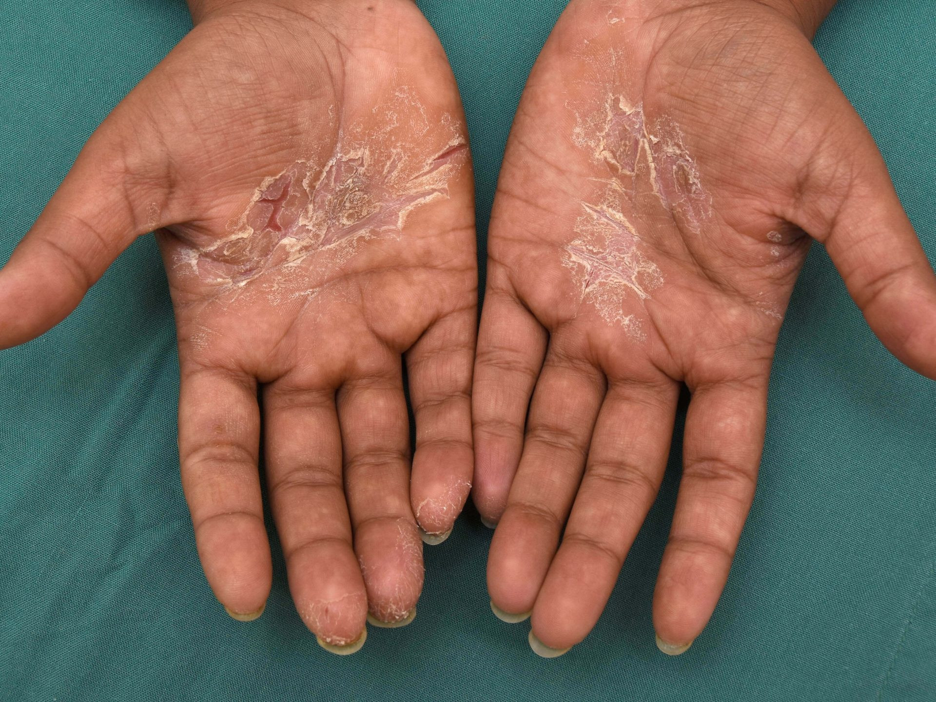 Disease Ecthyma | AI Care