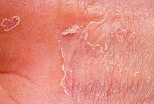 Penyakit Eksim (Dermatitis) - Definisi, Penyebab, Gejala, dan Tata ...