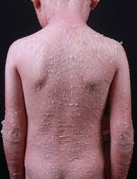 Erythroderma - Definisi, Penyebab, Gejala, dan Tata Laksana | AI Care