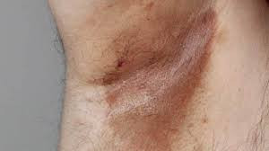 Disease Erythrasma | AI Care