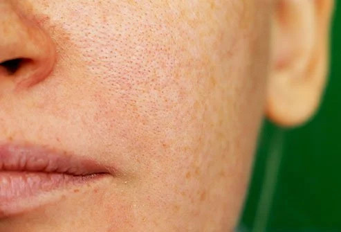 Chloasma - Definition, Causes, Symptoms, and Treatment | AI Care