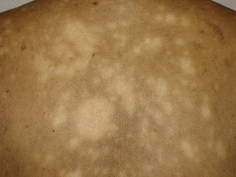 Callus - Definisi, Penyebab, Gejala, dan Tata Laksana | AI Care