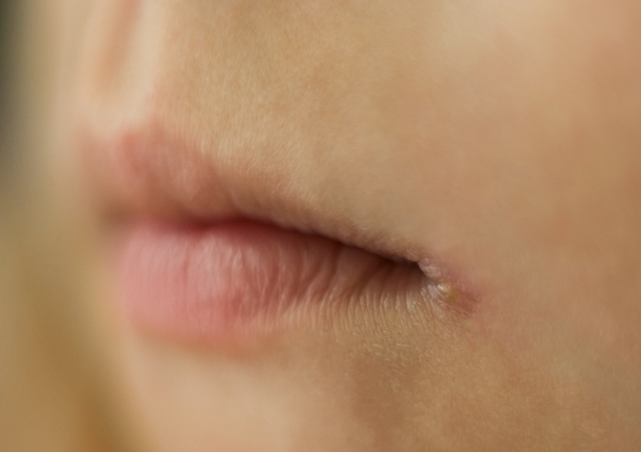 Angular Cheilitis - Definition, Causes, Symptoms, and Treatment | AI Care