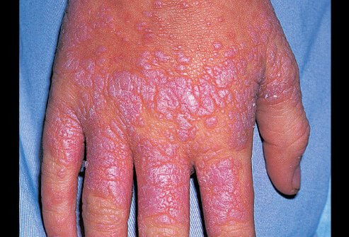 Disease Lichen Planus | AI Care