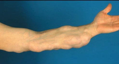 Lipoma - Definition, Causes, Symptoms, and Treatment | AI Care