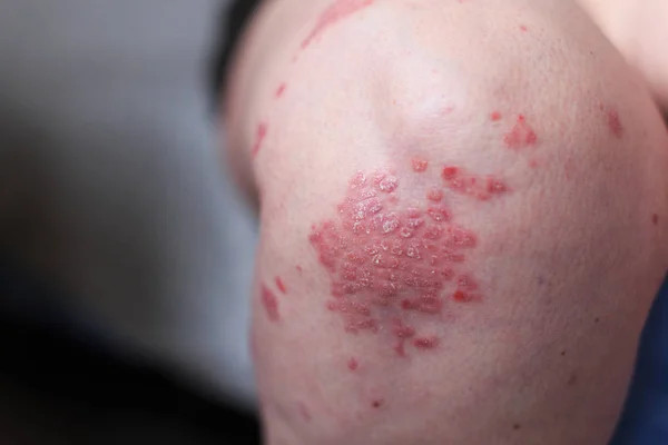 Psoriasis Vulgaris - Definisi, Penyebab, Gejala, dan Tata Laksana | AI Care
