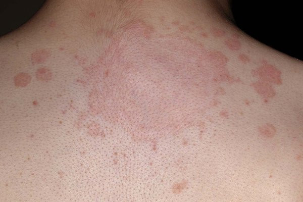 Penyakit Infeksi Jamur Badan (Tinea Korporis, Kruris, dan Manus ...