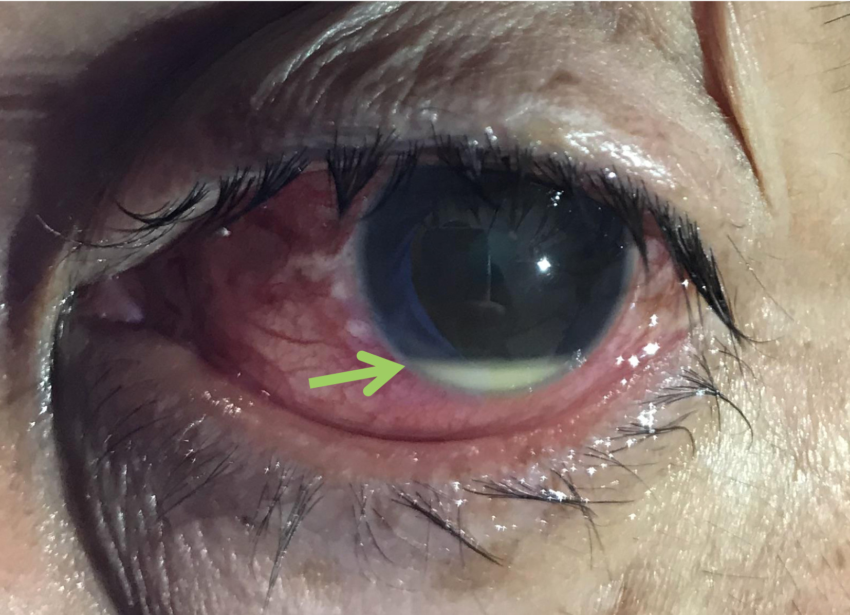 Hypopyon - Definisi, Penyebab, Gejala, dan Tata Laksana | AI Care