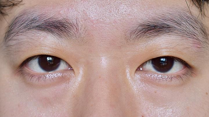 Epicanthus - Definition, Causes, Symptoms, and Treatment | AI Care