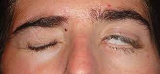 Lagophthalmos - Definition, Causes, Symptoms, and Treatment | AI Care