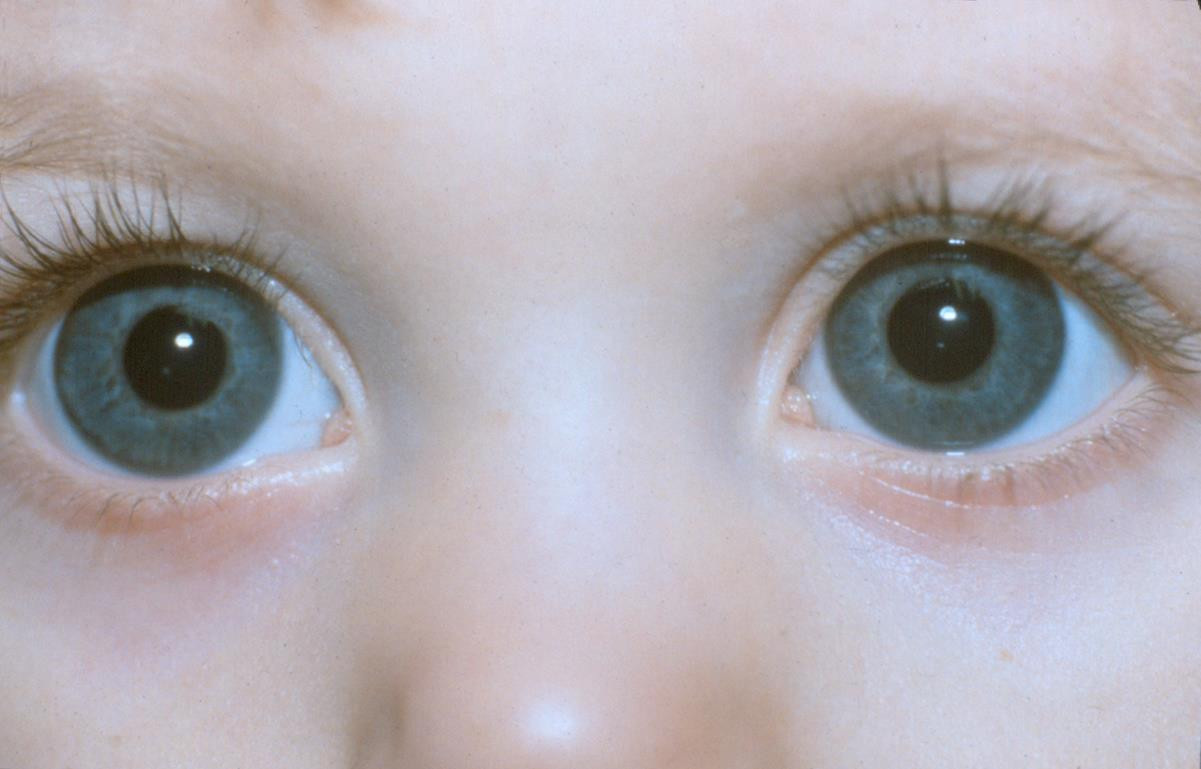 Megalocornea - Definisi, Penyebab, Gejala, dan Tata Laksana | AI Care