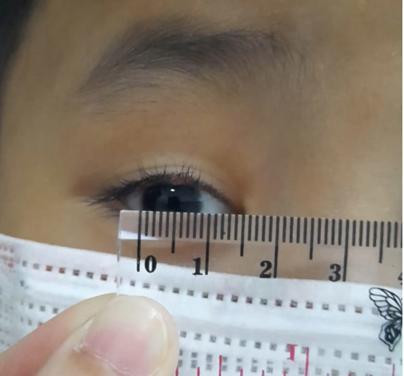 Microcornea - Definition, Causes, Symptoms, and Treatment | AI Care