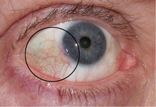 Pinguecula - Definisi, Penyebab, Gejala, dan Tata Laksana | AI Care