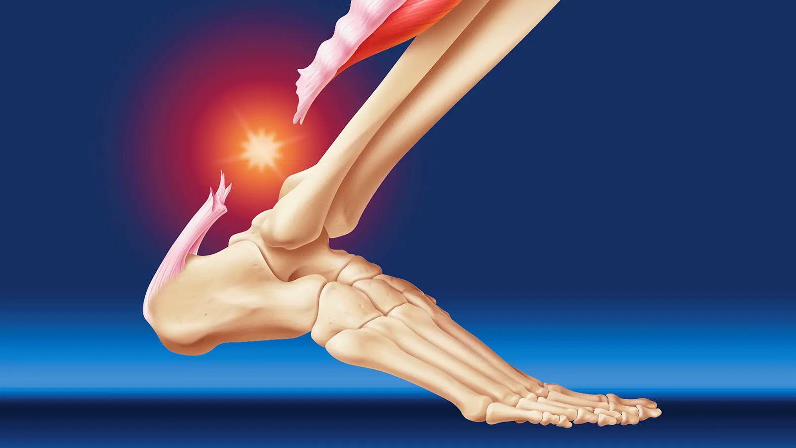 Tendon Injury - Definisi, Penyebab, Gejala, dan Tata Laksana | AI Care