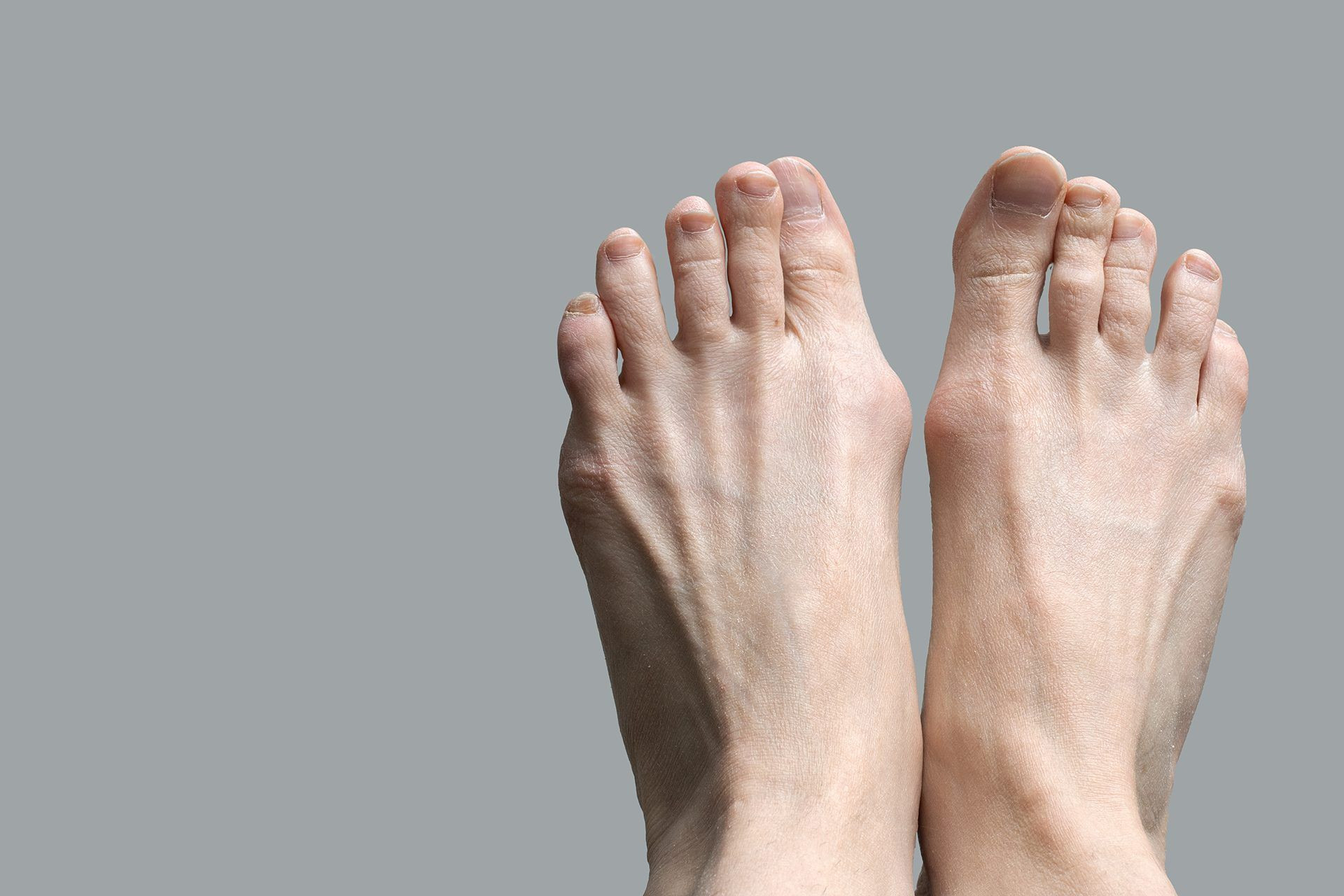 Penyakit Hallux Valgus - Definisi, Penyebab, Gejala, dan Tata Laksana ...