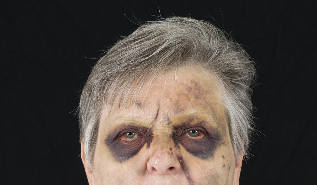 Basilar Skull Fracture - Definisi, Penyebab, Gejala, dan Tata Laksana ...