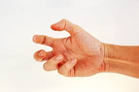 Ulnar Nerve Palsy - Definisi, Penyebab, Gejala, dan Tata Laksana | AI Care