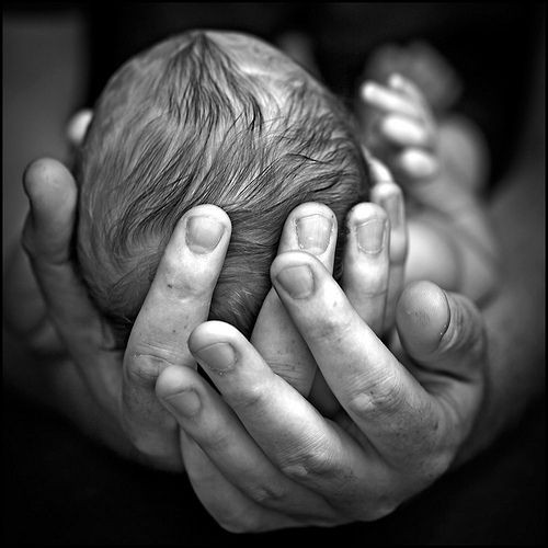 Encephalocele - Definisi, Penyebab, Gejala, dan Tata Laksana | AI Care