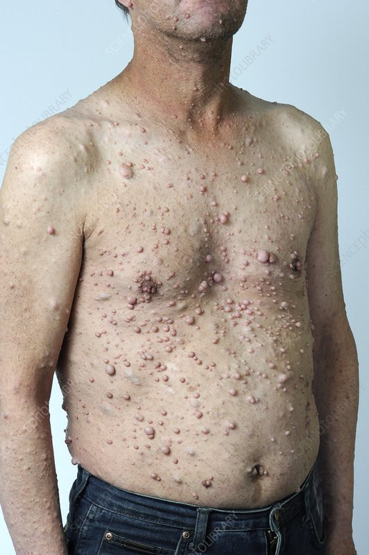 Disease Neurofibromatosis | AI Care