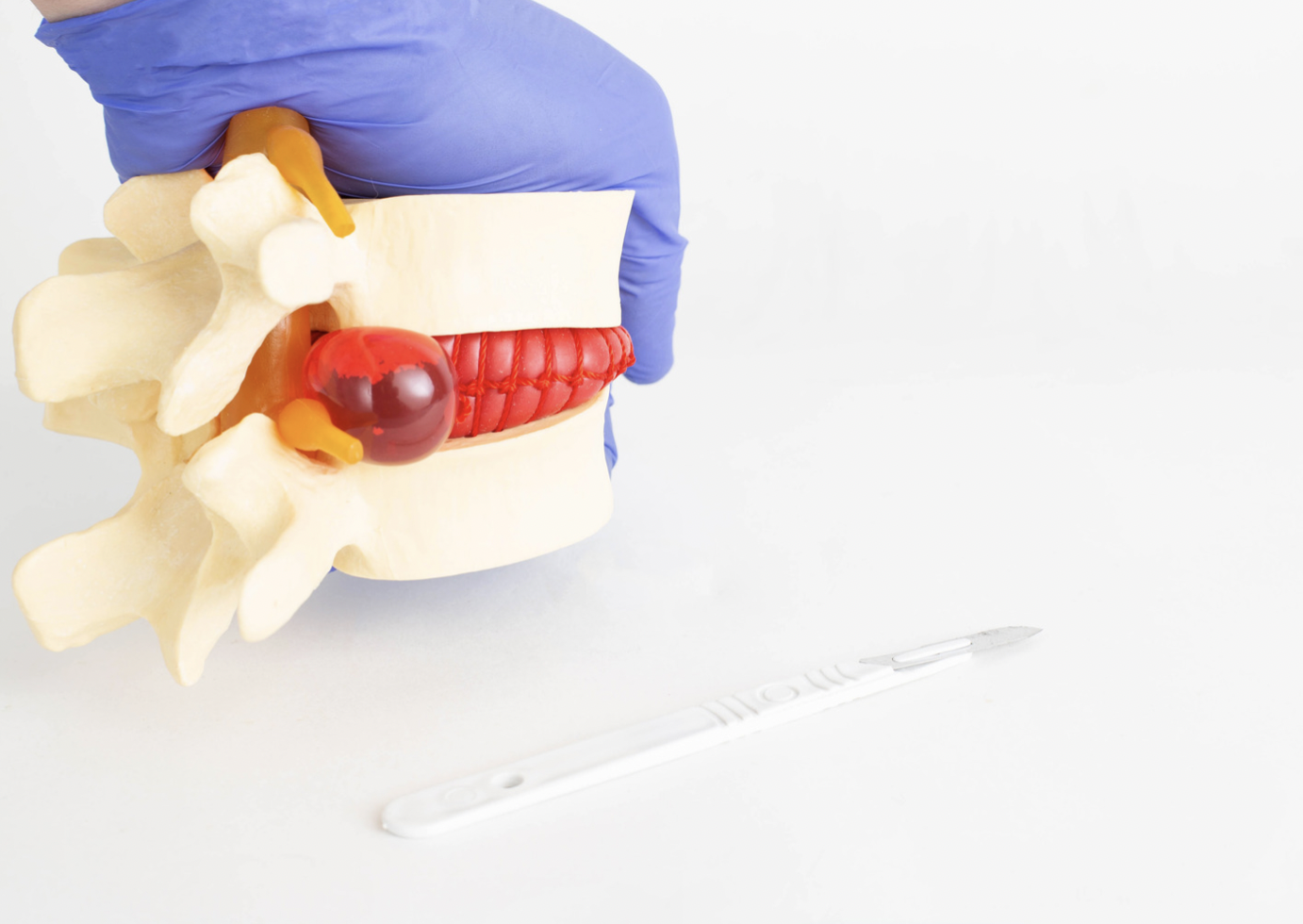 Disease Dorsal Root Syndrome | AI Care