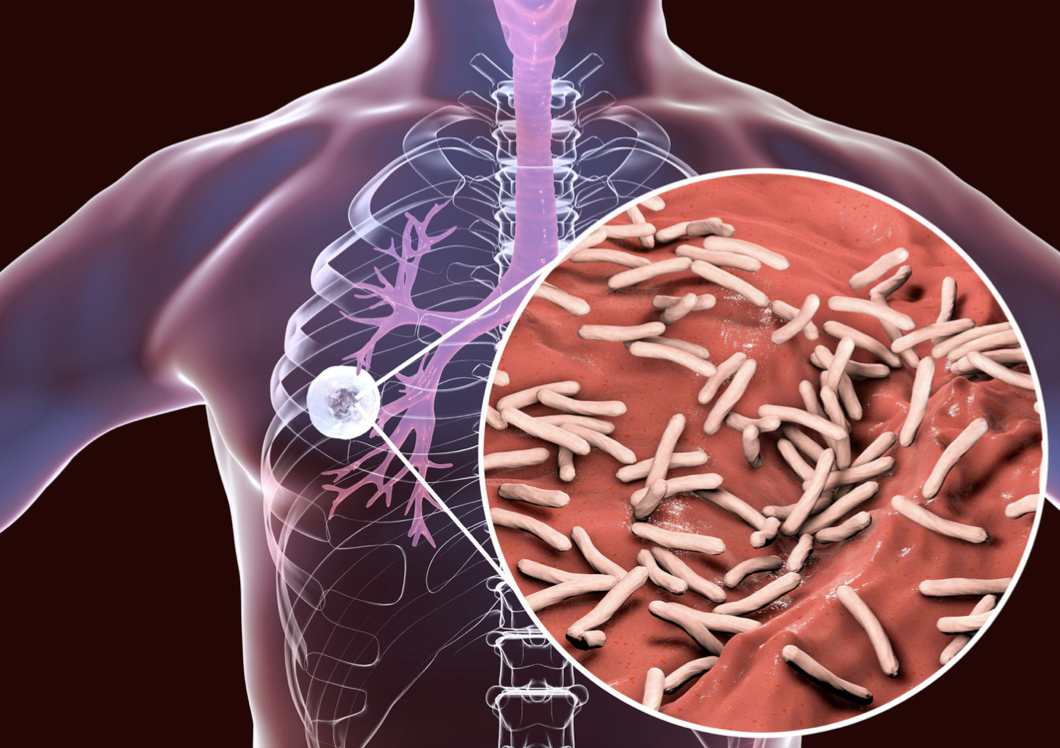 Pulmonary Tuberculosis - Definisi, Penyebab, Gejala, dan Tata Laksana ...
