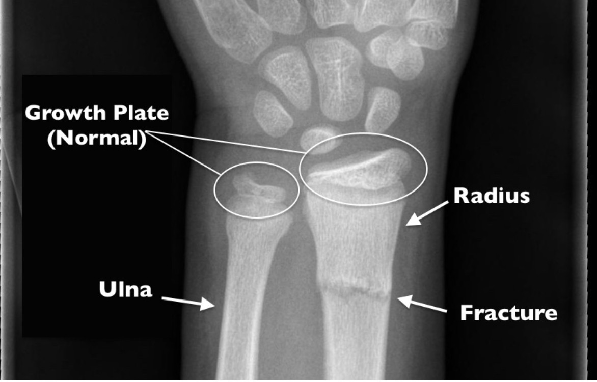 Fracture - Definisi, Penyebab, Gejala, dan Tata Laksana | AI Care